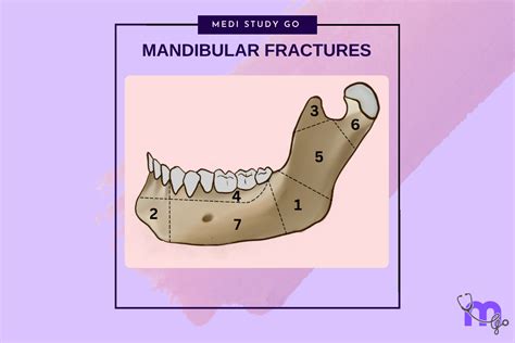 Mandibular Fractures Classification Systems And Clinical Relevance