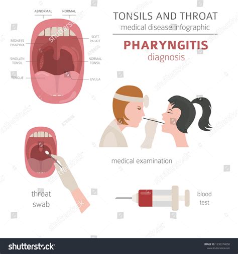 Tonsils Throat Diseases Pharyngitis Symptoms Treatment Stock Vector
