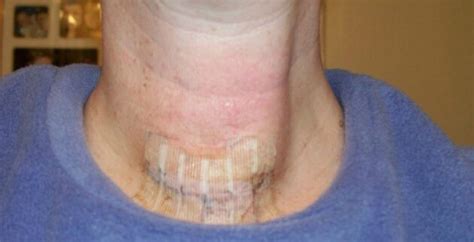 Heres What To Expect After Thyroid Surgery My Post Thyroid Surgery