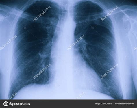 Frontal Radiograph Two Lungs Stock Photo PantherMediaSeller 341042852
