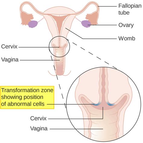 Cervical Cancer Causes Symptoms And Signs Treatment