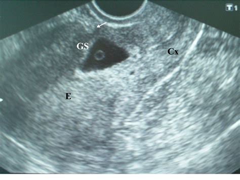 Figure 1 From Cesarean Scar Pregnancy Successfully Managed To Term