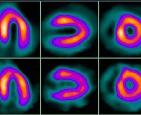 Myocardial Perfusion Imaging