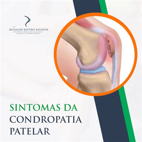 Sintomas Da Condropatia Patelar Dr Reinaldo Keitiro Katayose I