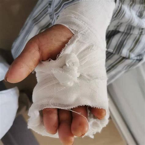 男子被电锯锯断手指，医生3小时手术保“指”成功陈吉滨马师傅武汉