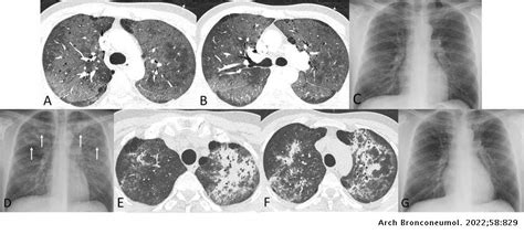 Pneumocystis Jirovecii Immune Reconstitution Inflammatory Syndrome