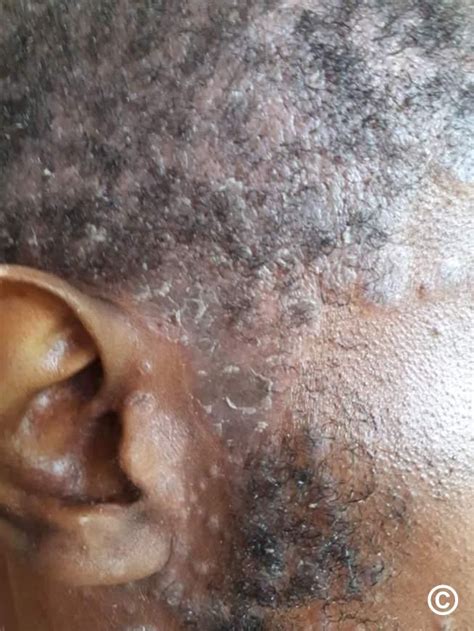 Psoriasis Scalp Psoriasis