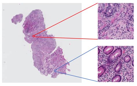 Multi Stage Pathological Image Classification Using Semantic Segmentation Deepai