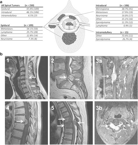 Overview Of Spinal Tumors Leading To Spinal Cord Compression In Our