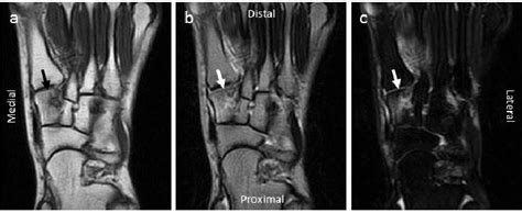 Figure 5 From Isolated Nondisplaced Medial Cuneiform Fractures Report Of Two Semantic Scholar