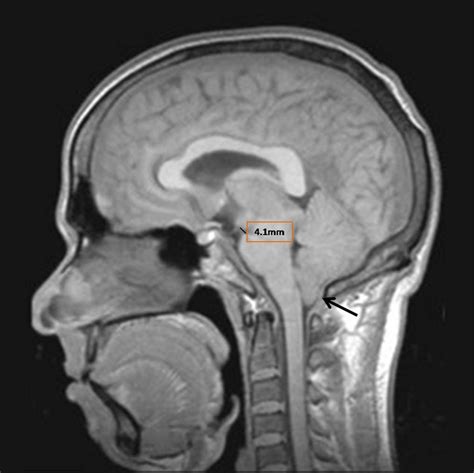 Sag T1w Image Showing Tonsillar Herniation Arrow And Reduced