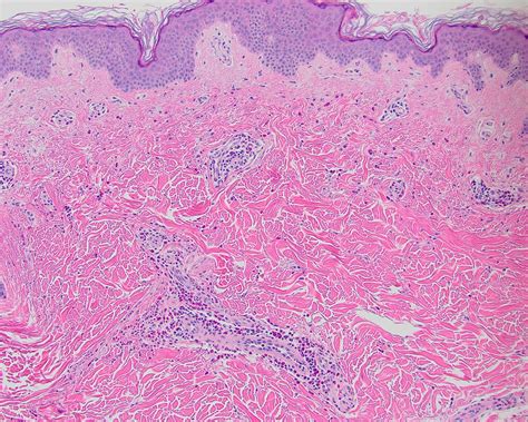 Pathology Outlines Dermal Hypersensitivity Reaction