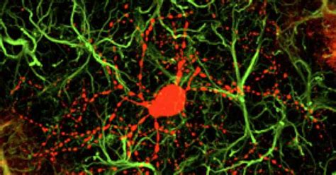 Glia To Neuron Conversion Gene Therapy Can Treat Huntingtons Disease
