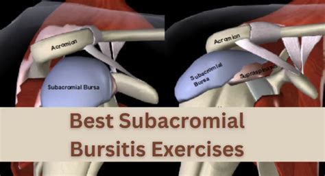 Subacromial Bursitis Exercises Effective Exercises For Pain Relief