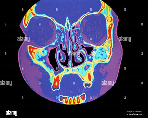 Sinusitis Coloured Computed Tomography Ct Scan Vertically Through A