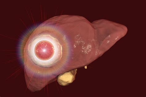T Vec Treatment Shows Promise For Treating Advanced Stage Liver Tumours