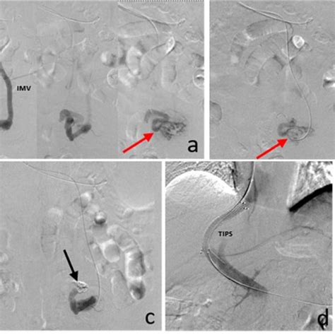 Stomal Varices At Ileostomy Site In A Patient With Cirrhosis And Portal Download Scientific