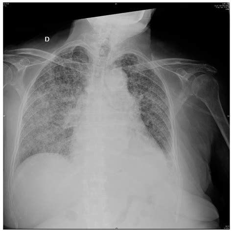 Miliary Tuberculosis Presenting With Hyponatremia And Ards In An 82
