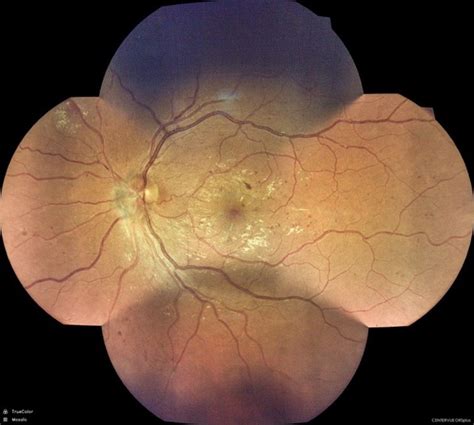 Cukrzyca Typu 1 I Zaawansowana Retinopatia Cukrzycowa Retinopatia