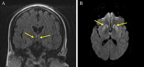 Mri In A Confirmed Case Of Vcjd With Appearances More Characteristic Of