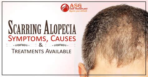 Scarring Alopecia Symptoms Causes And Treatments Available