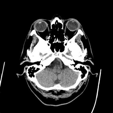 Subarachnoid Cisterns Stroke Manual