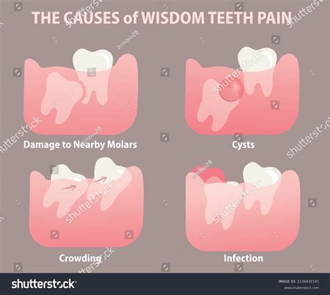 Illustration Impacted Wisdom Teeth Wisdom Teeth Stock Vector Royalty Free 2236932145