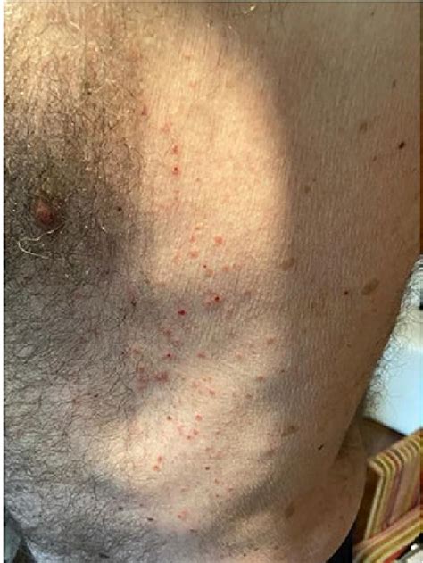 Pruritic Erythematous Papulovesicular Rash That Preceded The Onset Of