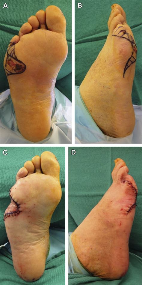 Partial Foot Amputations For Salvage Of The Diabetic Lower Extremity
