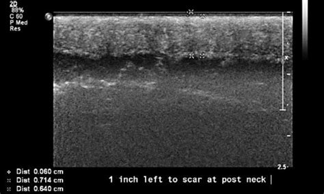Successful Treatment Of Scleredema Diabeticorum By Combining Local Puva