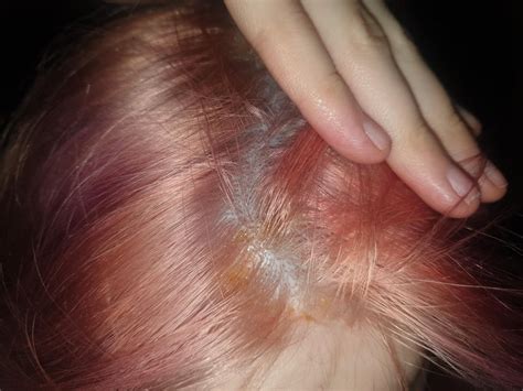 Please Someone I Burnt My Scalp With Bleach And Im Worried That I