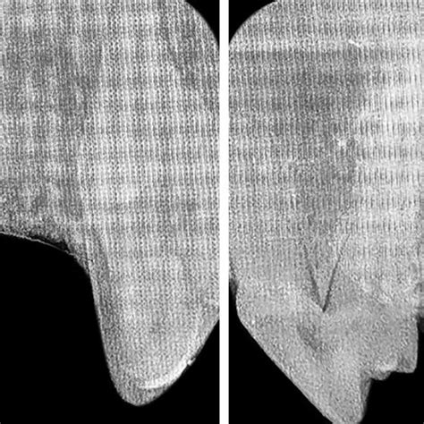 A And B A Radiograph Of Ba Placed To Rebuild The Maxillary Defect At