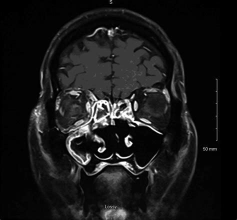 Mri Of Brain Showing Periorbital Cellulitis And Periosteal Elevation