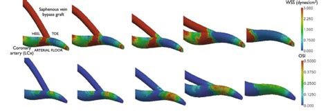 comparison of top wss and bottom osi for five different bypass