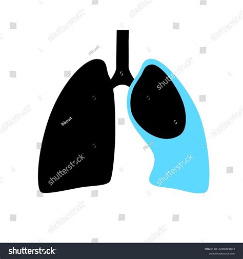 Pneumothorax Disease Flat Vector Collapsed Lung Stock Vector Royalty