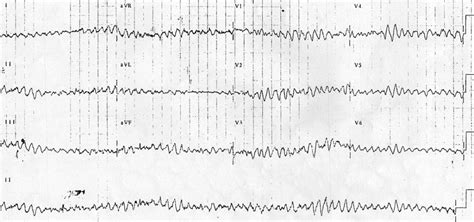 Ventricular Flutter Litfl Ecg Library Diagnosis