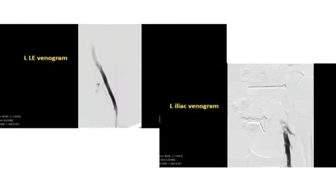 Coding Complex Vascular Cases AAPC Knowledge Center