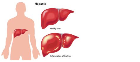Hepatitis On Flowvella Presentation Software For Mac Ipad And Iphone