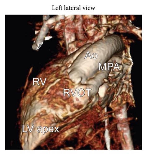 A Neonatal Patient With A Superoinferior Ventricle Dorv Subaortic