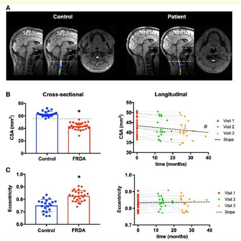 Spinal Cord Morphometry A Brain T 1 Images Showing Automated