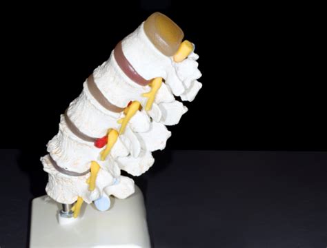 Difference Between Anterolisthesis And Retrolisthesis Difference