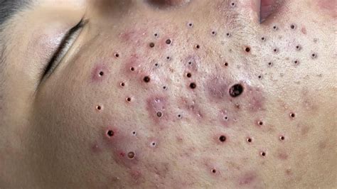 Suri Nguyen Blackheads Acne Treatment Whiteheads Removal Cyst Pimple