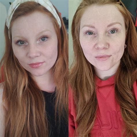 Final Banda Now My Scabs Are Off And Its Been A Couple Of Weeks Im Absolutely Delighted With