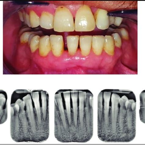 Gingivectomy Gingivoplasty Internal Bevel Incision And Sutures Download Scientific Diagram