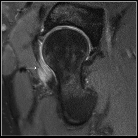 Mri Assessment Of Anatomy And Pathology Of The Iliofemoral Ligament