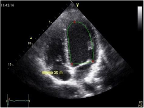 An Example Of A Left Ventricle Ultrasound Image The Three Red Dots Download Scientific Diagram