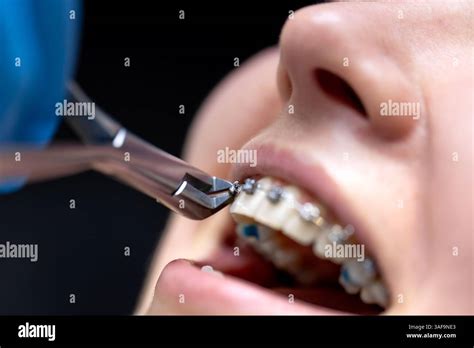 Dental Procedure For Installing Braces Close Up Dentistry Braces On