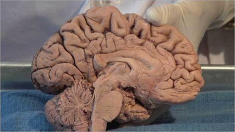 Brain Dissection 05 The Ventricles