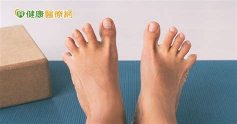 不只外觀！「大拇趾外翻」姿勢、步態、關節都受影響 拖延治療恐需手術 生活 Ctwant