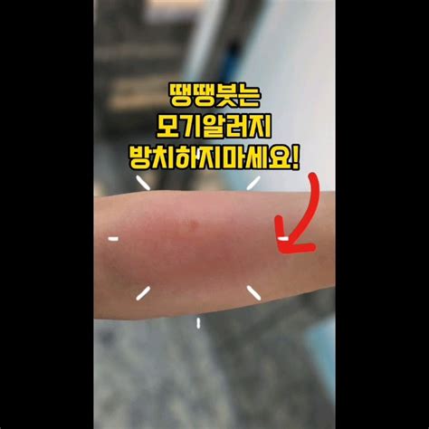 모기알러지 대처법 모기비상약 상비약 긁지마세요 Youtube